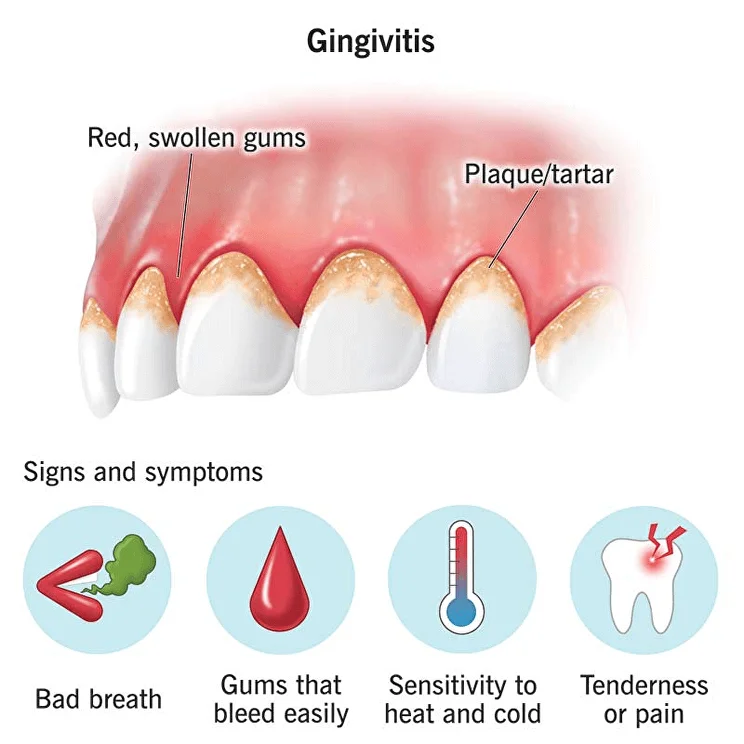mild gingivitis icd 10